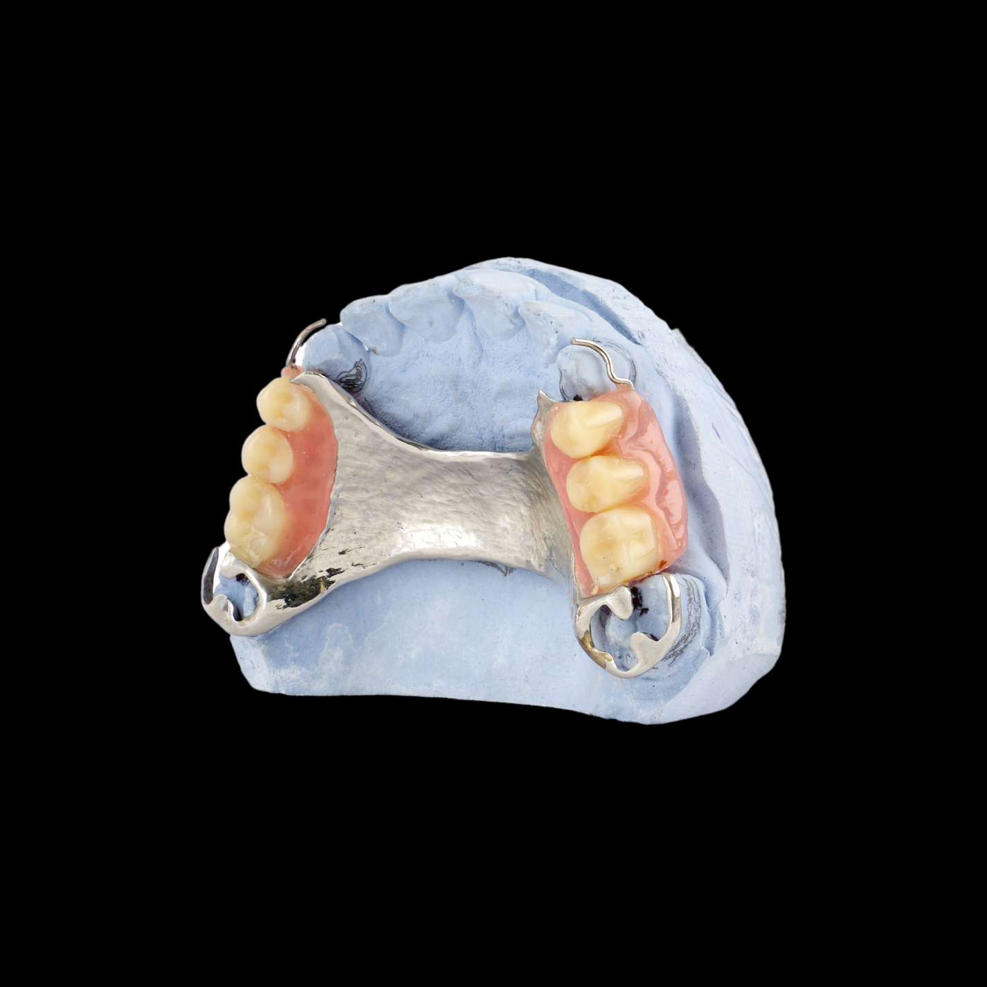 Chrome Casting – Genesis Dental Lab