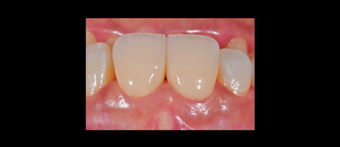 Chrome Casting – Genesis Dental Lab